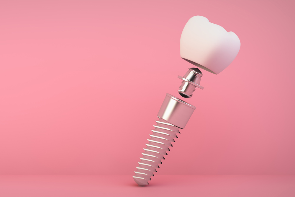 Εμφυτεύματα δοντιών - Προσθετική δοντιών | The Dental Home