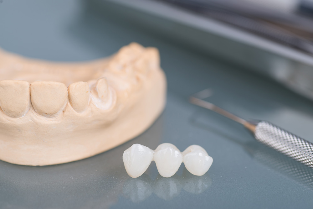 Γέφυρα Δοντιών | The Dental Home